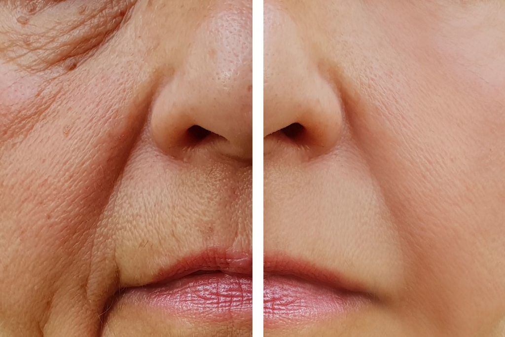 Best treatment for wrinkles on face store